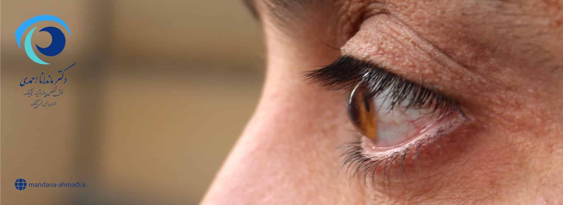 قوز قرنیه چیست؟ + سوالات متداول | دکتر ماندانا احمدی